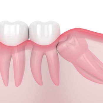wisdom teeth sutures dry socket